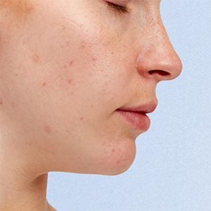 Dermatologische Tips voor een Zuivere Huid | CeraVe België